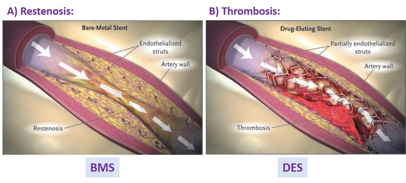 Stent technology in the treatment of coronary artery disease | Research ...