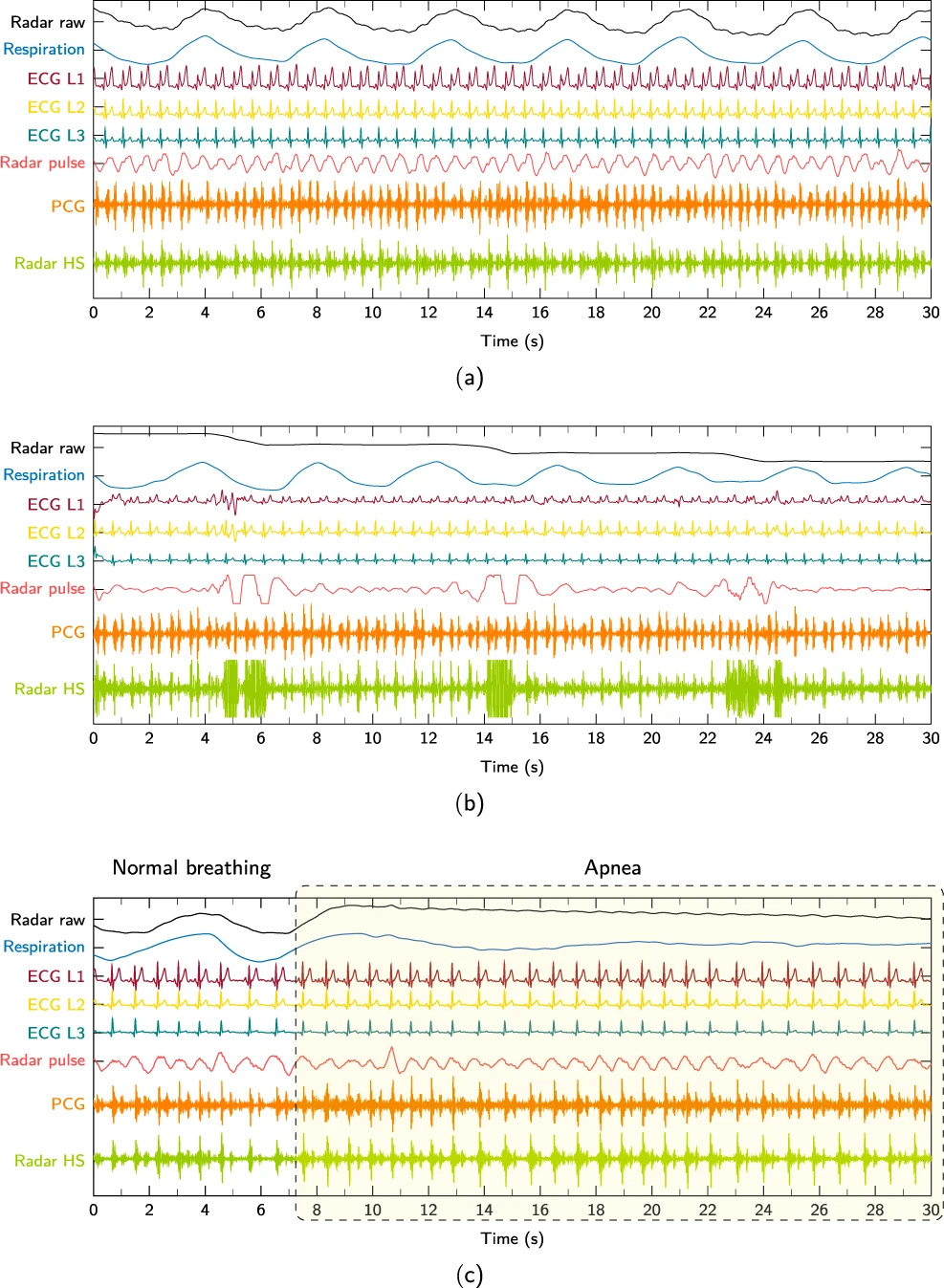 A dataset of radar-recorded heart sounds and vital signs including ...
