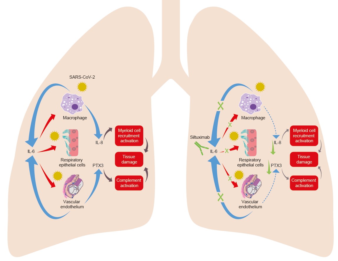 Siltuximab as an immune therapy to tackle severe COVID-19 | Research ...